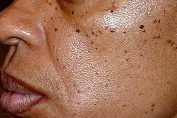 Amarose Skin Tag Remover Shark Tank What You Need To Learn