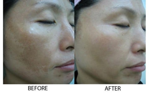 Lasers For Hyperpigmentation - Treatment at Dr. Al Rustom Laser Centre