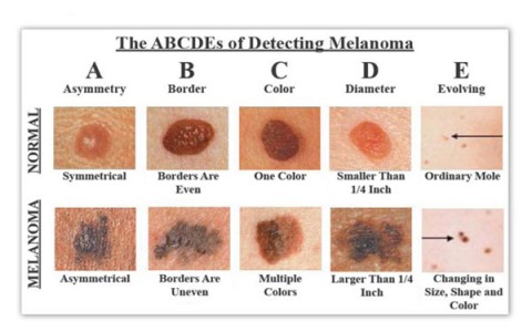 Moles are harmless but sometimes skin cancer can develop in or around