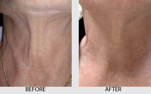 Intracel An Innovative, Proven Revolutionary Skin Resurfacing Technology