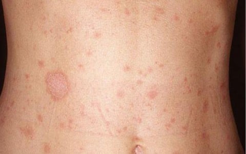 Pityriasis Rosea - Dr. Kamil Al Rustom Skin & Laser Centre