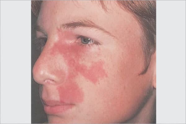 Vascular Nevus - Dr. Kamil Al Rustom Skin & Laser Centre