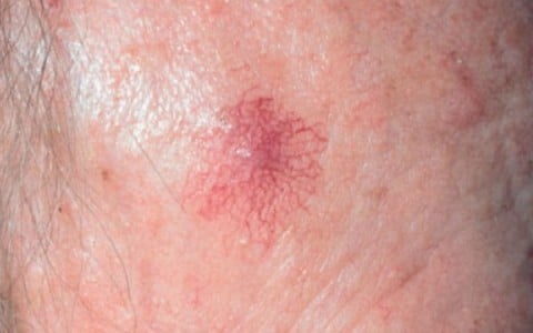Spider Nevus - Treatment at Dr. Al Rustom Skin & Laser Center